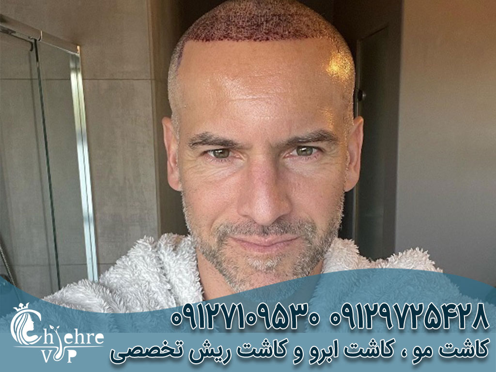 سن کاشت مو بررسی حداقل و حداکثر سن مناسب برای کاشت مو