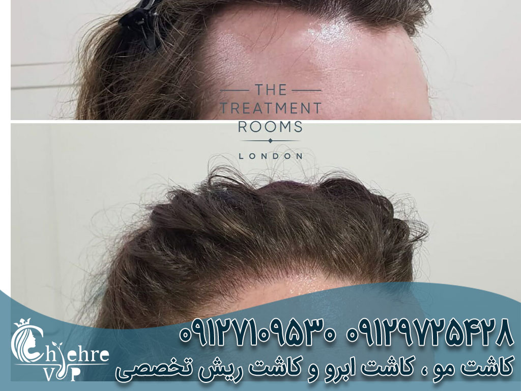 کاشت مو hrt - دکتر بهزاد دالوند