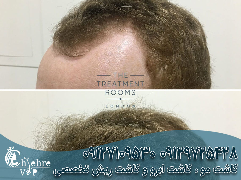 کاشت مو hrt - دکتر بهزاد دالوند